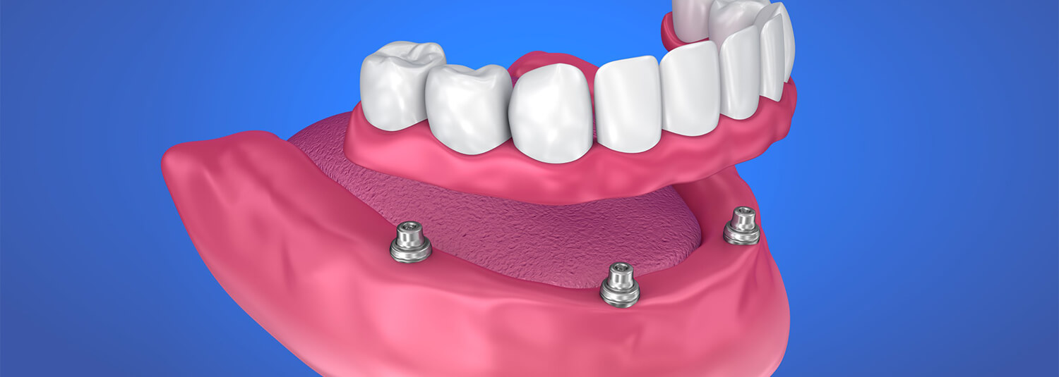 Optimale nazorg voor uw klikgebit - Implantologie - Expertise Kliniek ...