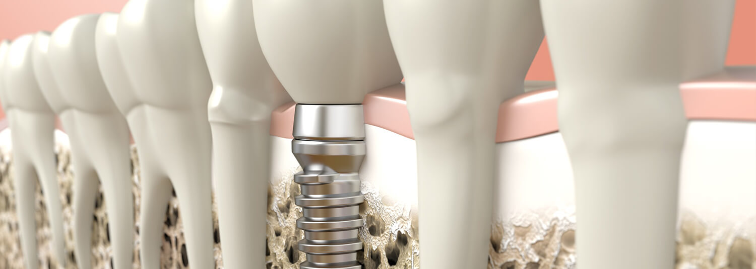 Ontsteking van implantaat, wat nu? - Implantologie - Expertise Kliniek ...